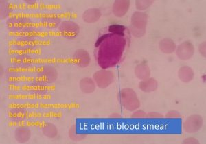 LE cell in blood smear: Definition, Introduction, Pathophysiology and lab