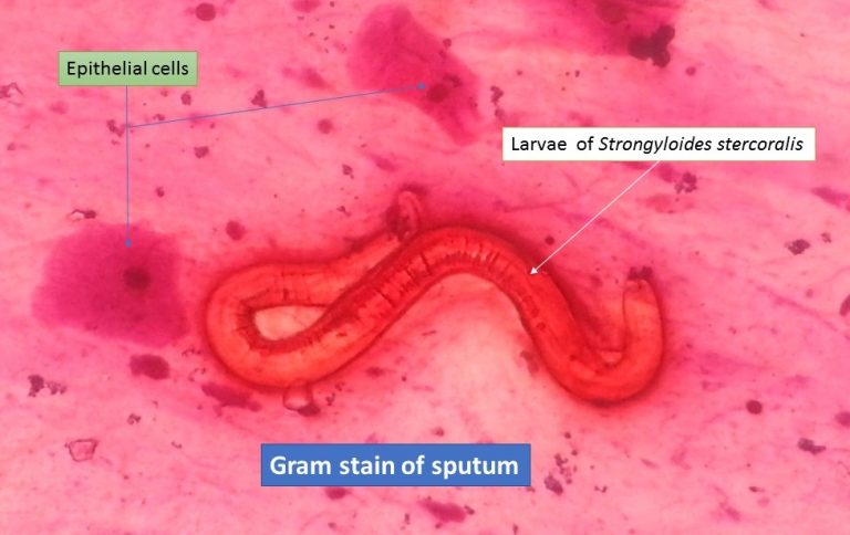 Strongyloides in gram stain of sputum and stool in details