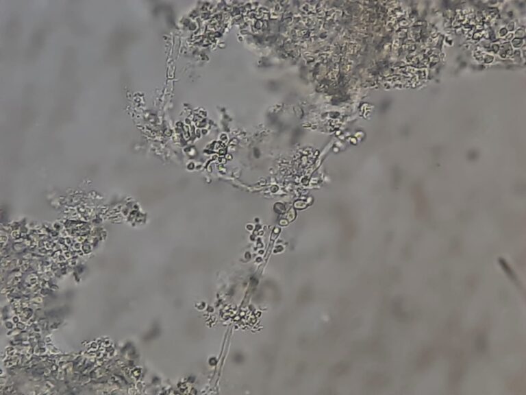 Fungal Elements in KOH Mount of Urine Microscopy- Introduction